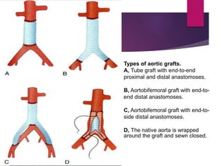USG of Aorta and Coeliac axis | PPTX
