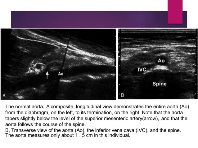 USG of Aorta and Coeliac axis | PPTX | Heart and Cardiovascular ...