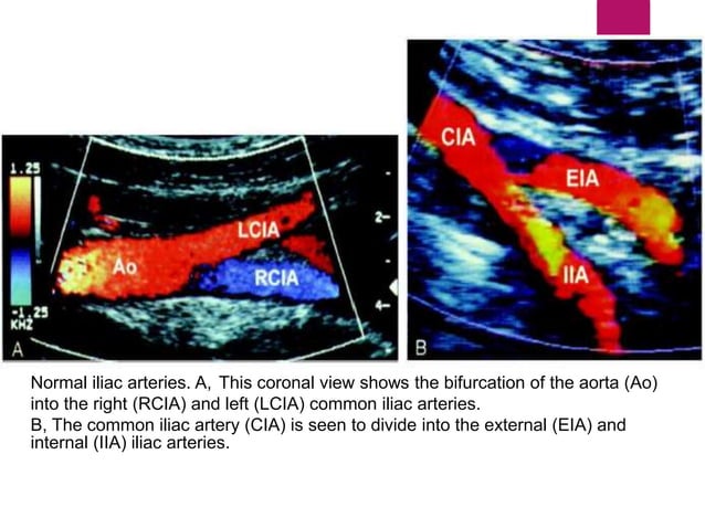 USG of Aorta and Coeliac axis | PPTX | Heart and Cardiovascular ...