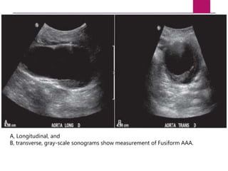 Aorta Anatomy Ultrasound