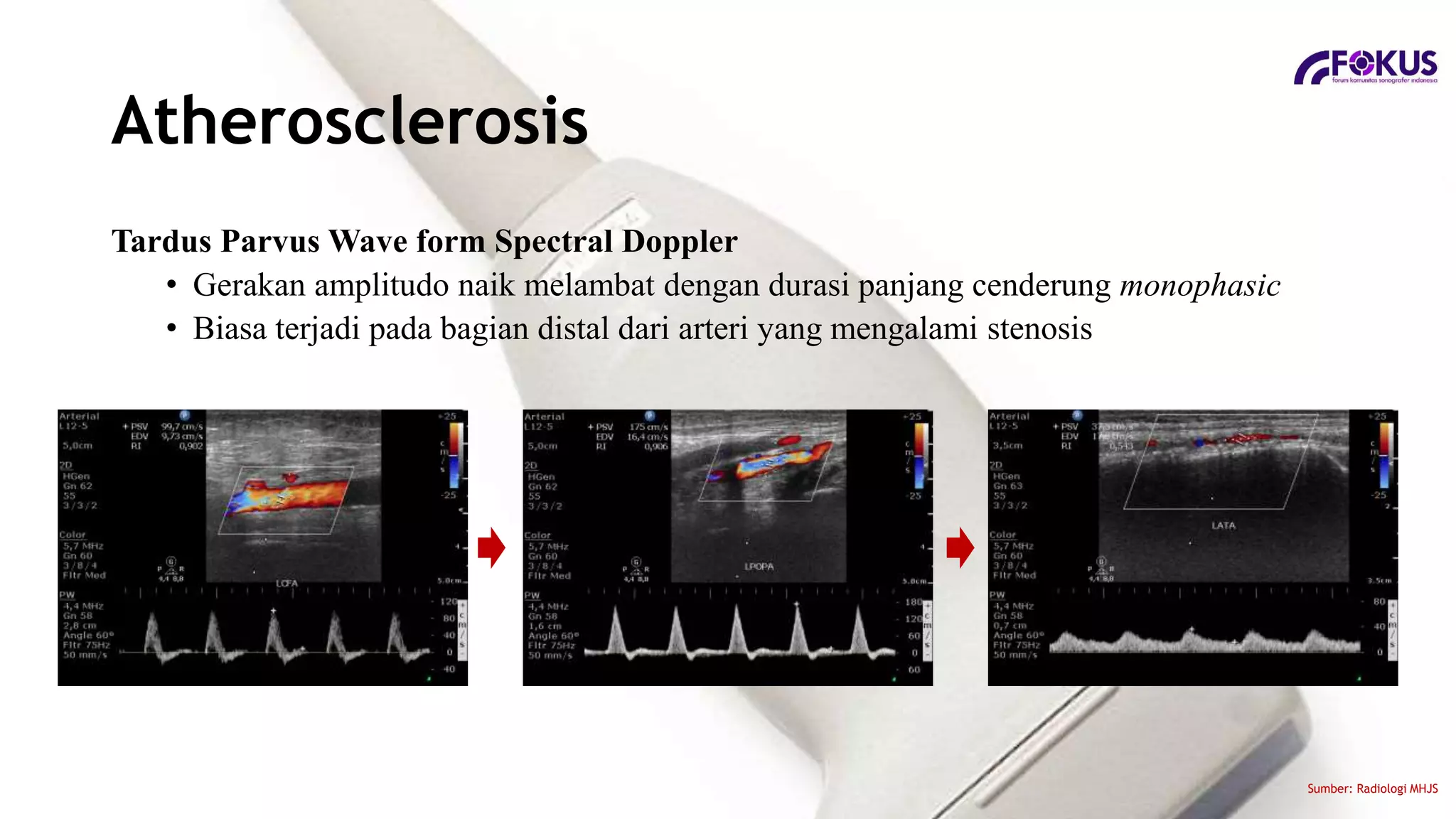 USG Arteri Extremitas Bawah/Inferior | PPTX