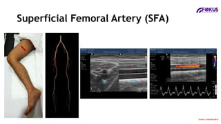 USG Arteri Extremitas Bawah/Inferior | PPTX