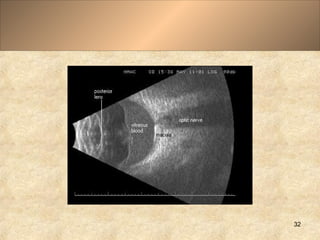 USG B Scan | PPT
