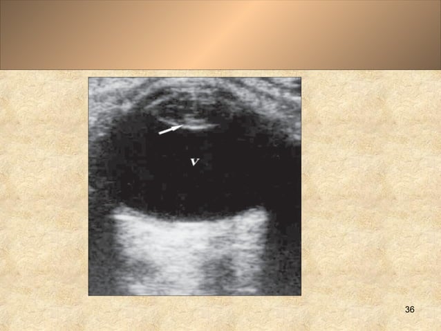 Usg B Scan
