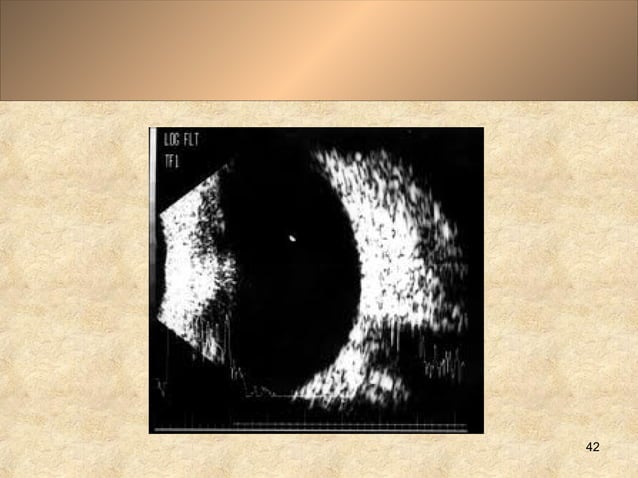 Usg B Scan
