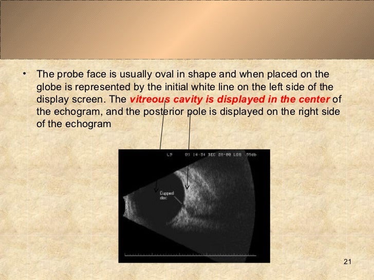 Usg B Scan