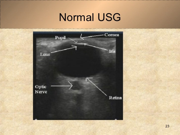 Usg B Scan