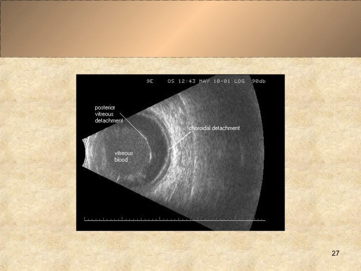 Usg B Scan