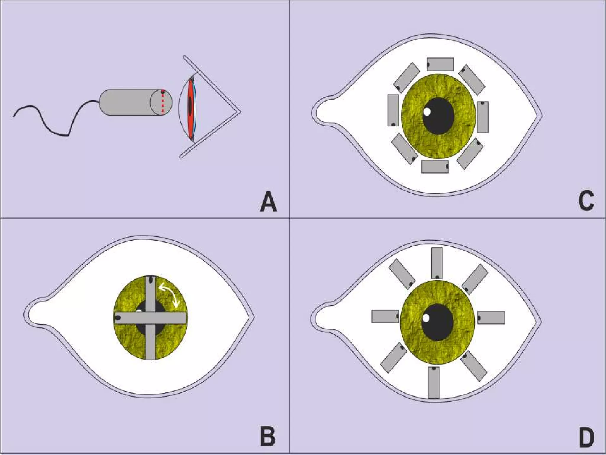 USG B SCAN OPHTHALMOLOGY | PDF