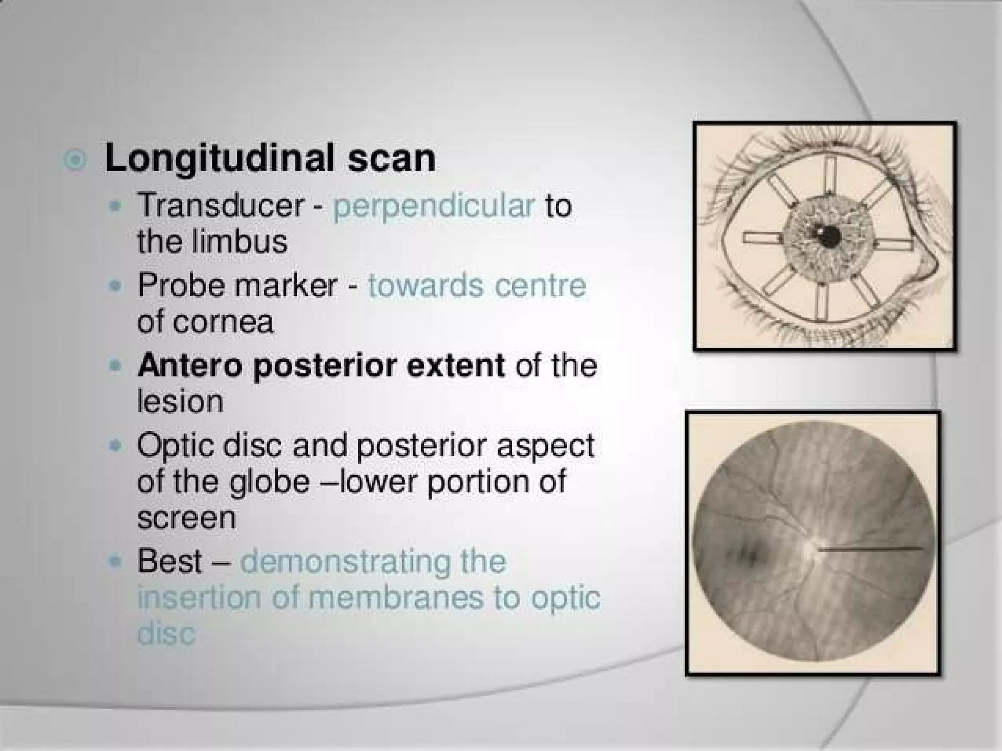 USG B SCAN OPHTHALMOLOGY | PDF