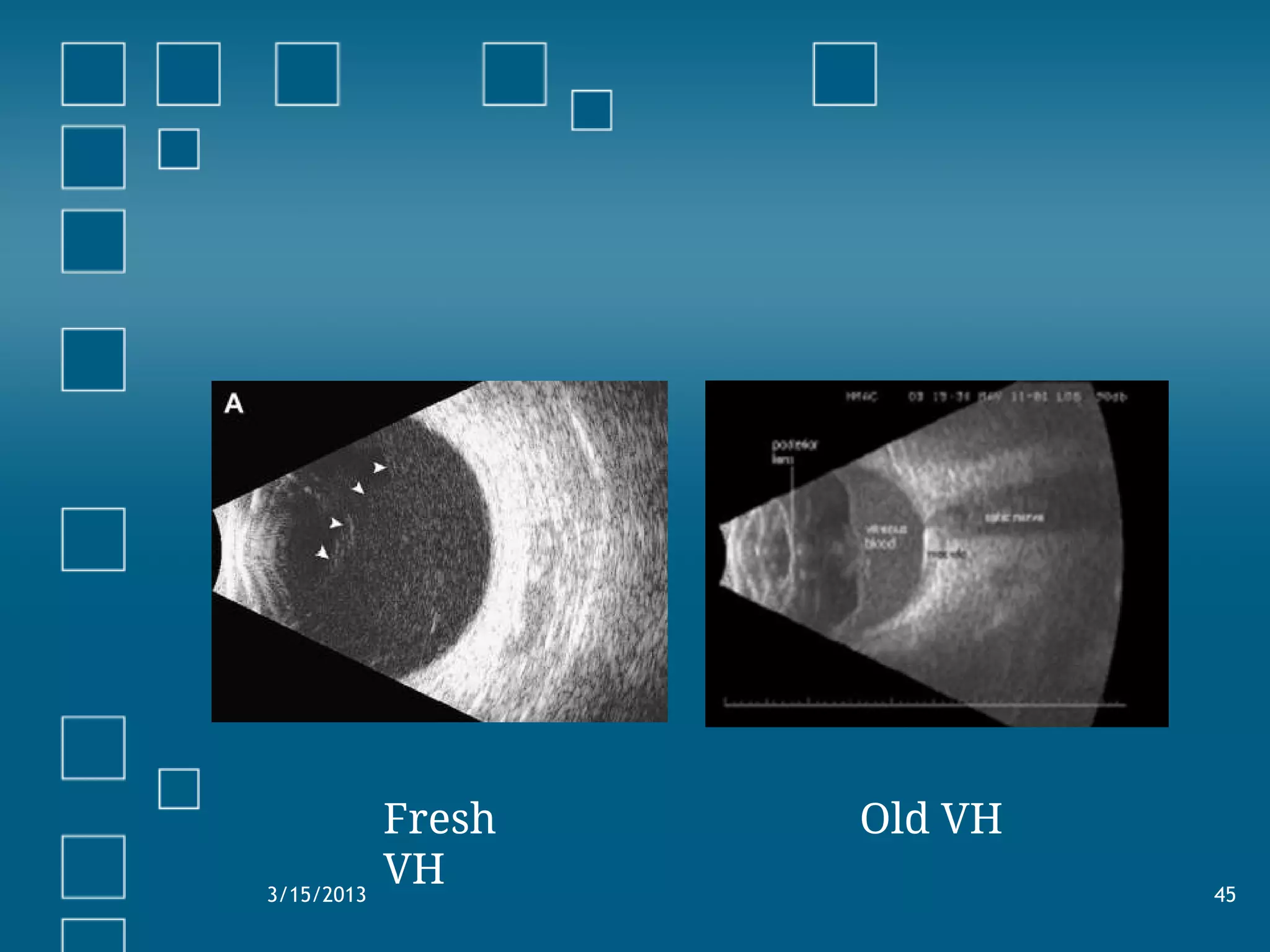 USG B SCAN OPHTHALMOLOGY | PDF