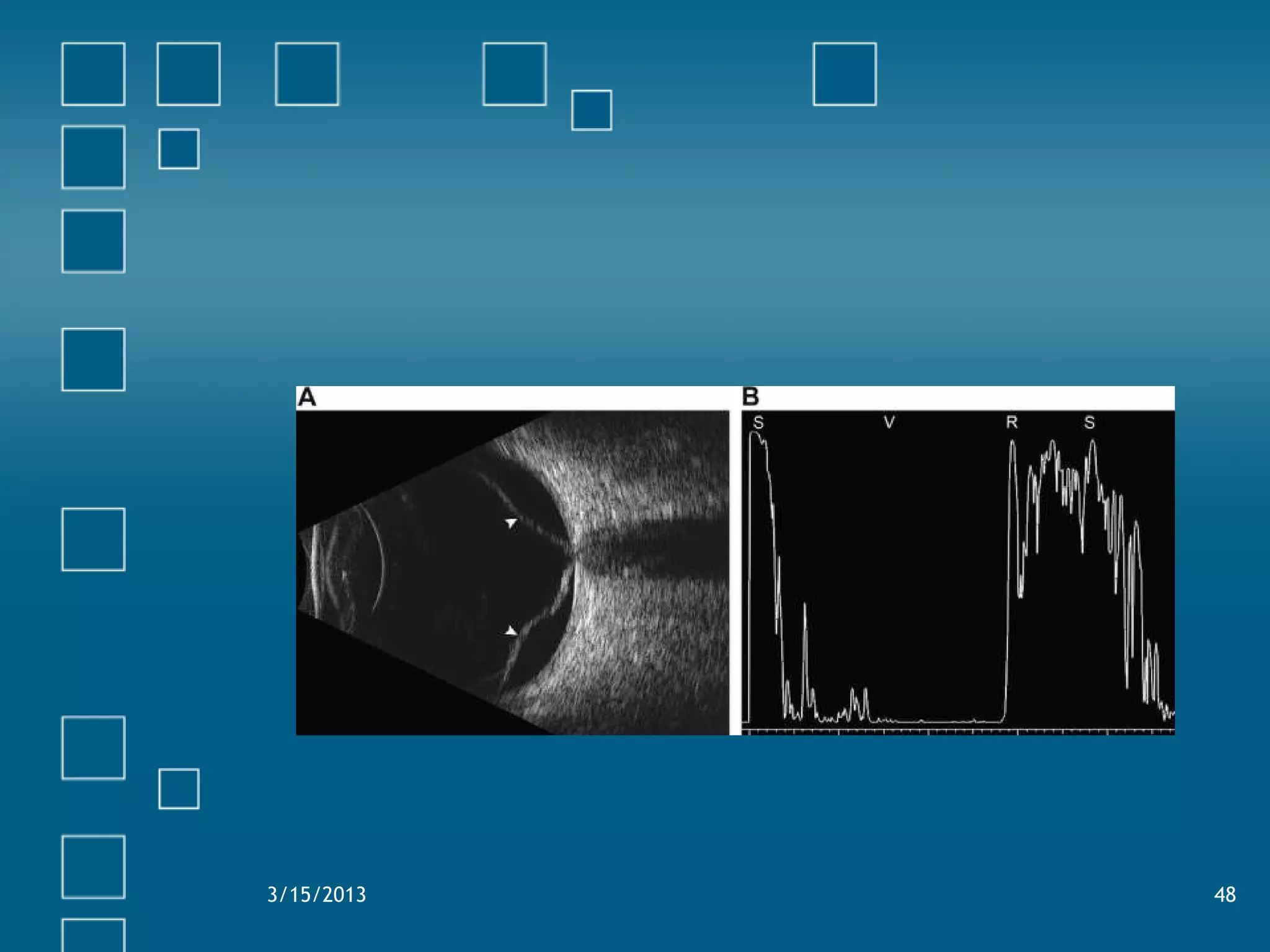 USG B SCAN OPHTHALMOLOGY | PDF