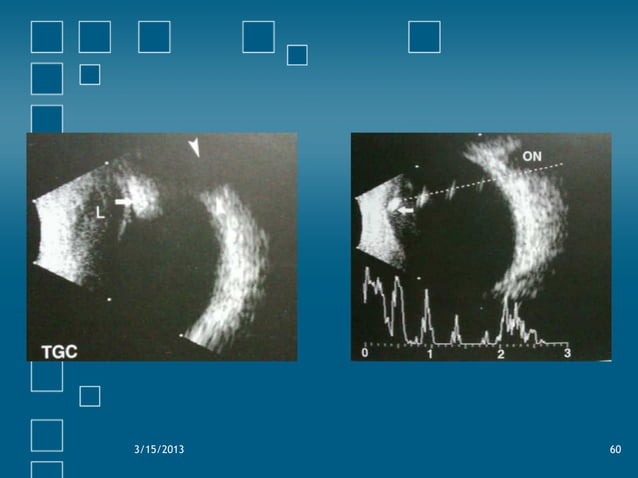 USG B SCAN OPHTHALMOLOGY | PDF