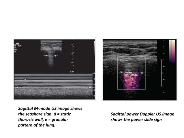 USG chest | PPTX | Lung and Respiratory Health | Diseases and Conditions