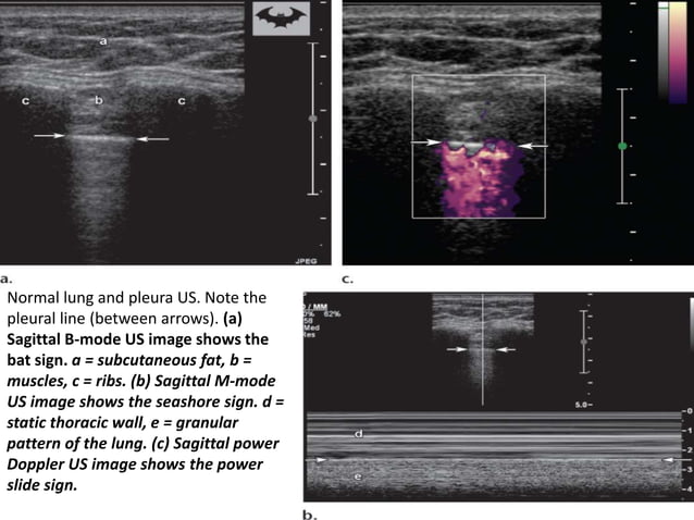 USG chest | PPTX | Lung and Respiratory Health | Diseases and Conditions