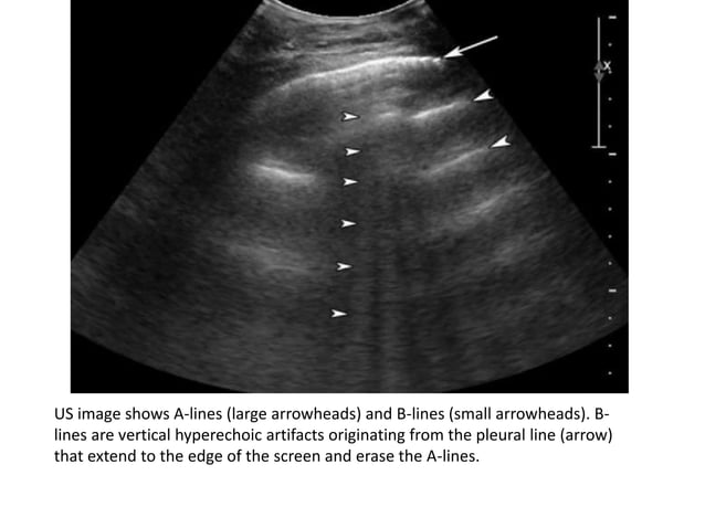 USG chest | PPTX | Lung and Respiratory Health | Diseases and Conditions
