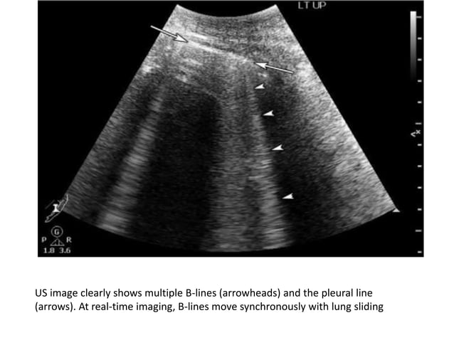 USG chest | PPTX | Lung and Respiratory Health | Diseases and Conditions