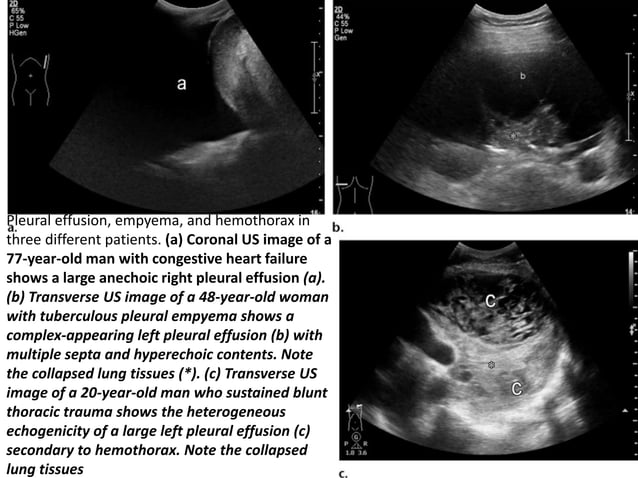 USG chest | PPTX | Lung and Respiratory Health | Diseases and Conditions