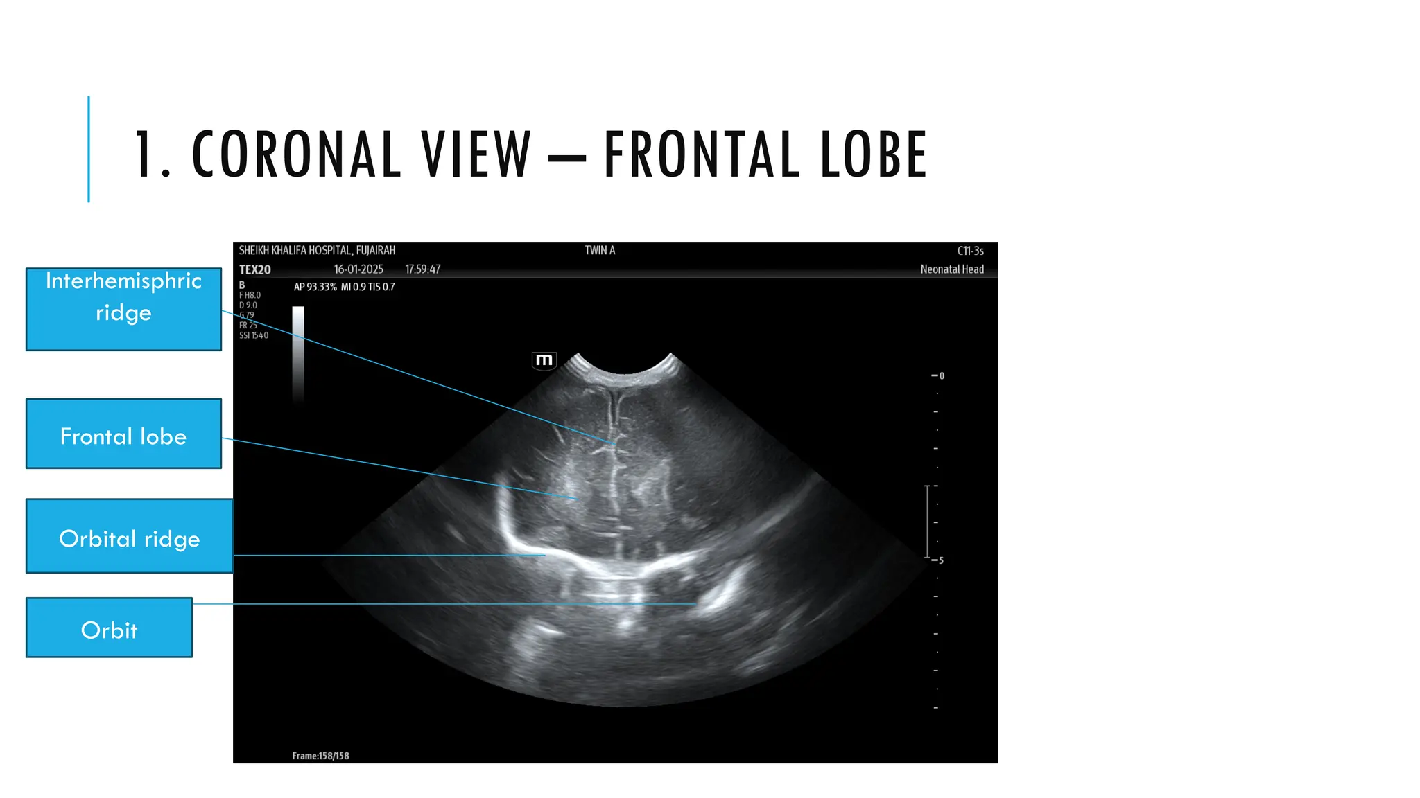 USG CRANIUM VIEWS, NEOPOCUS. Saggital views Coronal views.pptx