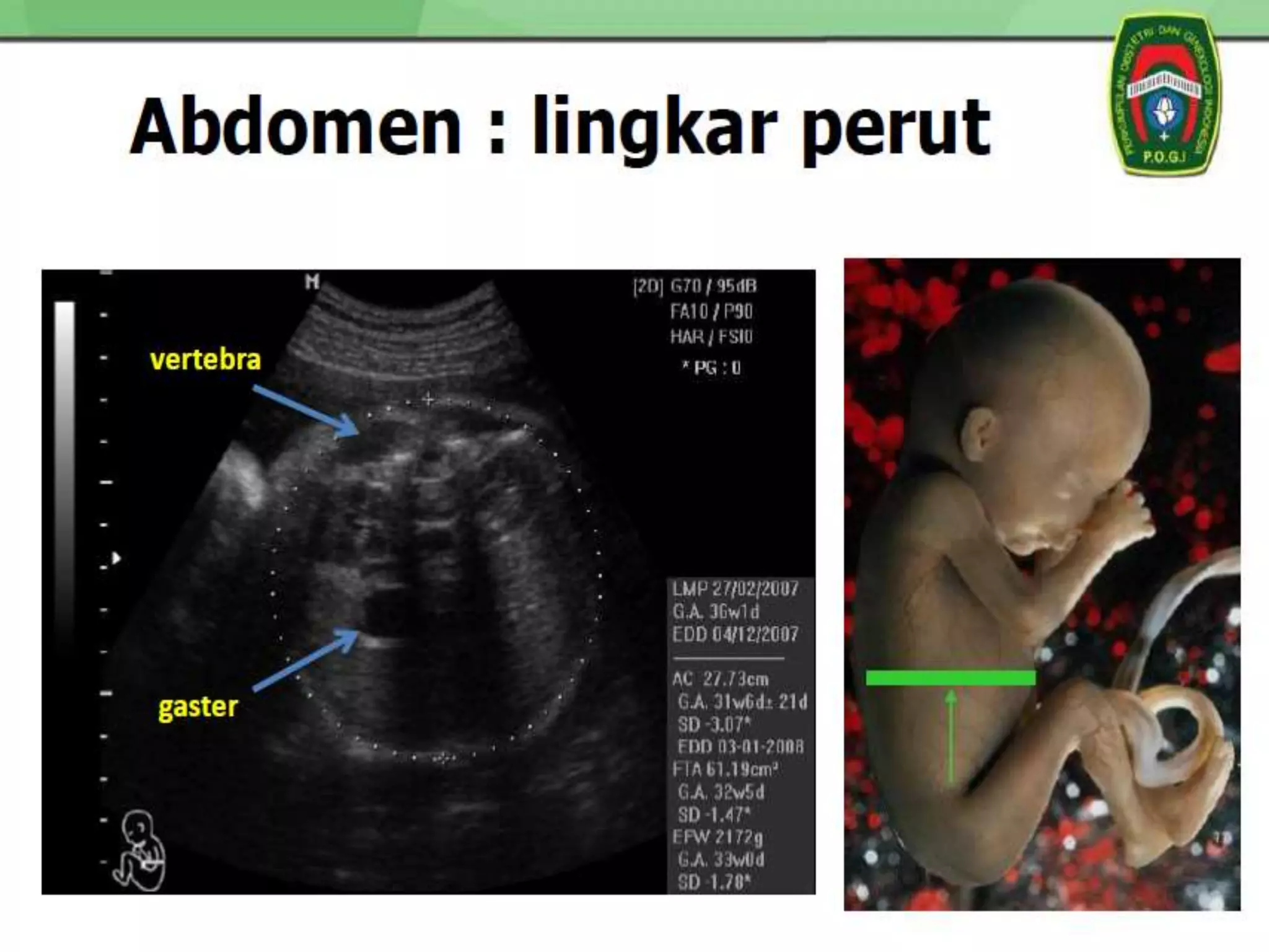 USG dan doppler dalam Obstetri-ginekologi 28-8-2021.pptx