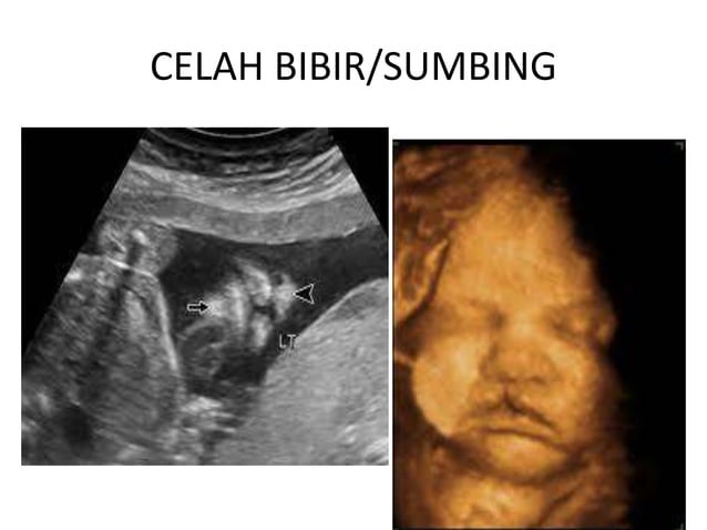 USG dan doppler dalam Obstetri-ginekologi 28-8-2021.pptx