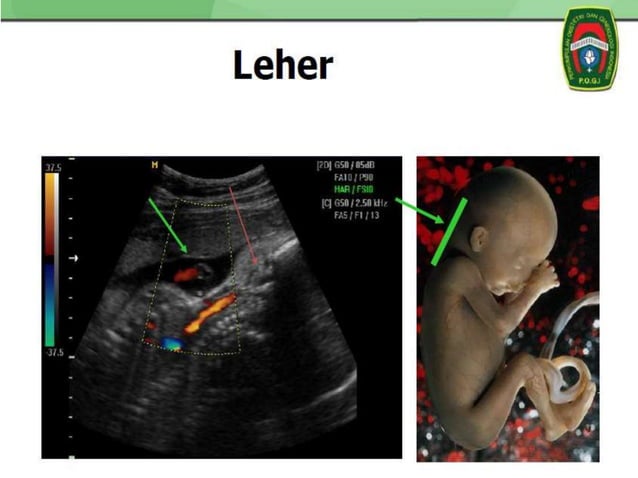 USG dan doppler dalam Obstetri-ginekologi 28-8-2021.pptx