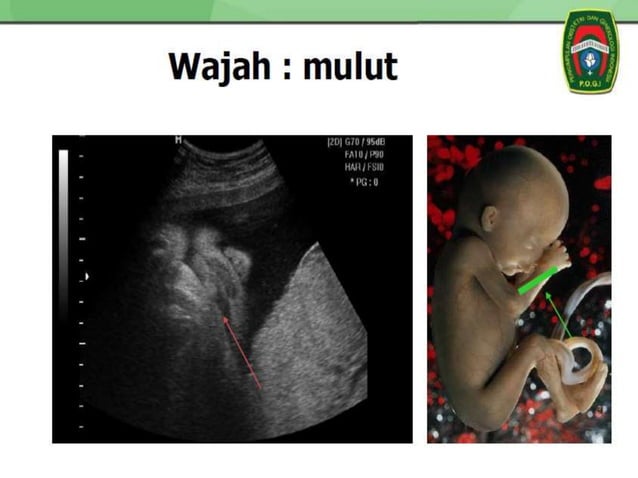USG dan doppler dalam Obstetri-ginekologi 28-8-2021.pptx