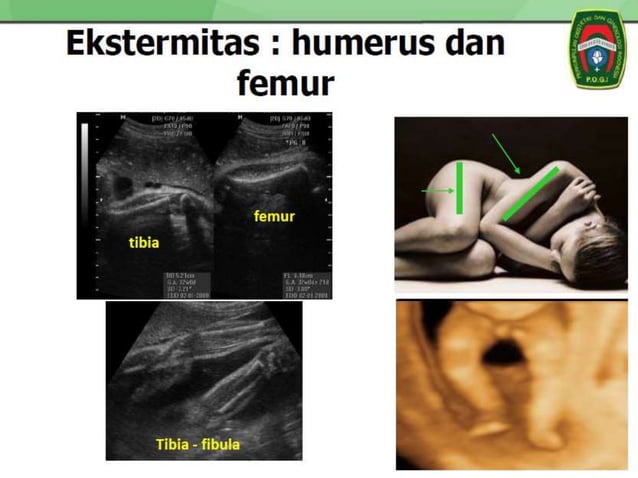 USG dan doppler dalam Obstetri-ginekologi 28-8-2021.pptx