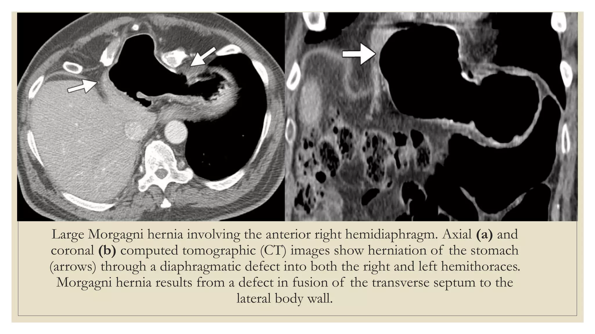 ULTRASONOGRAPHY OF DIAPHRAGM AND ITS CLINICAL IMPLICATION | PPTX