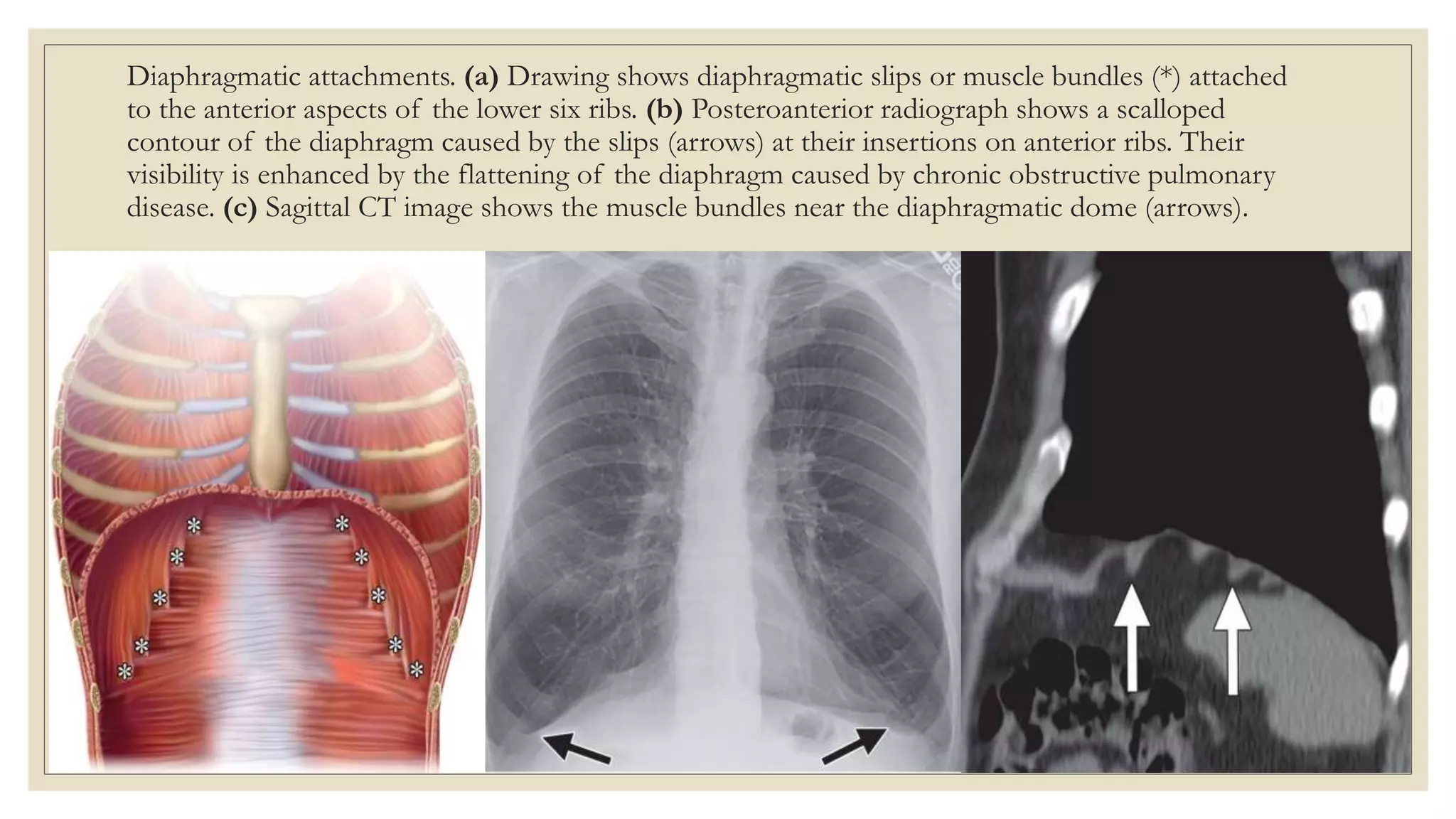 ULTRASONOGRAPHY OF DIAPHRAGM AND ITS CLINICAL IMPLICATION | PPTX