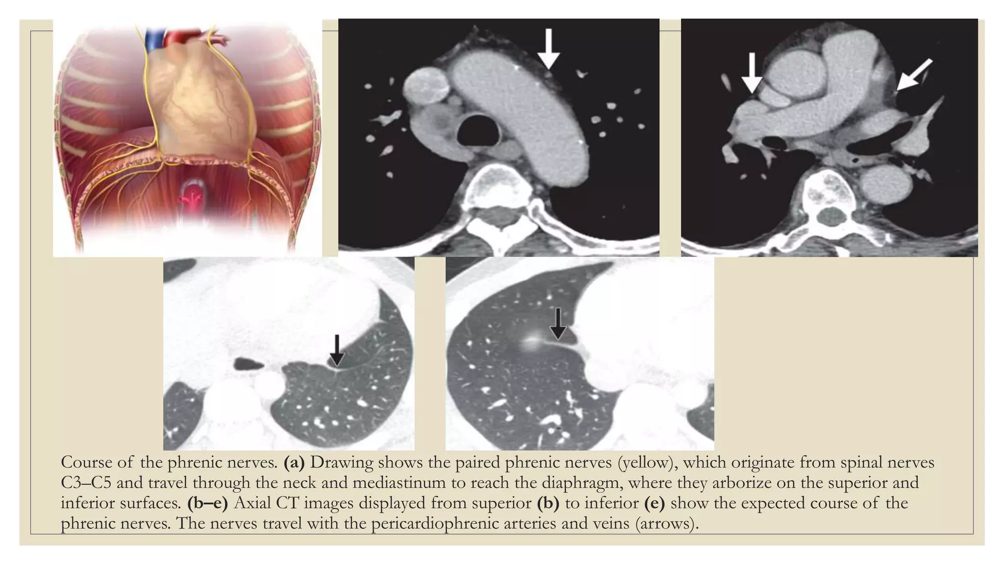 ULTRASONOGRAPHY OF DIAPHRAGM AND ITS CLINICAL IMPLICATION | PPTX