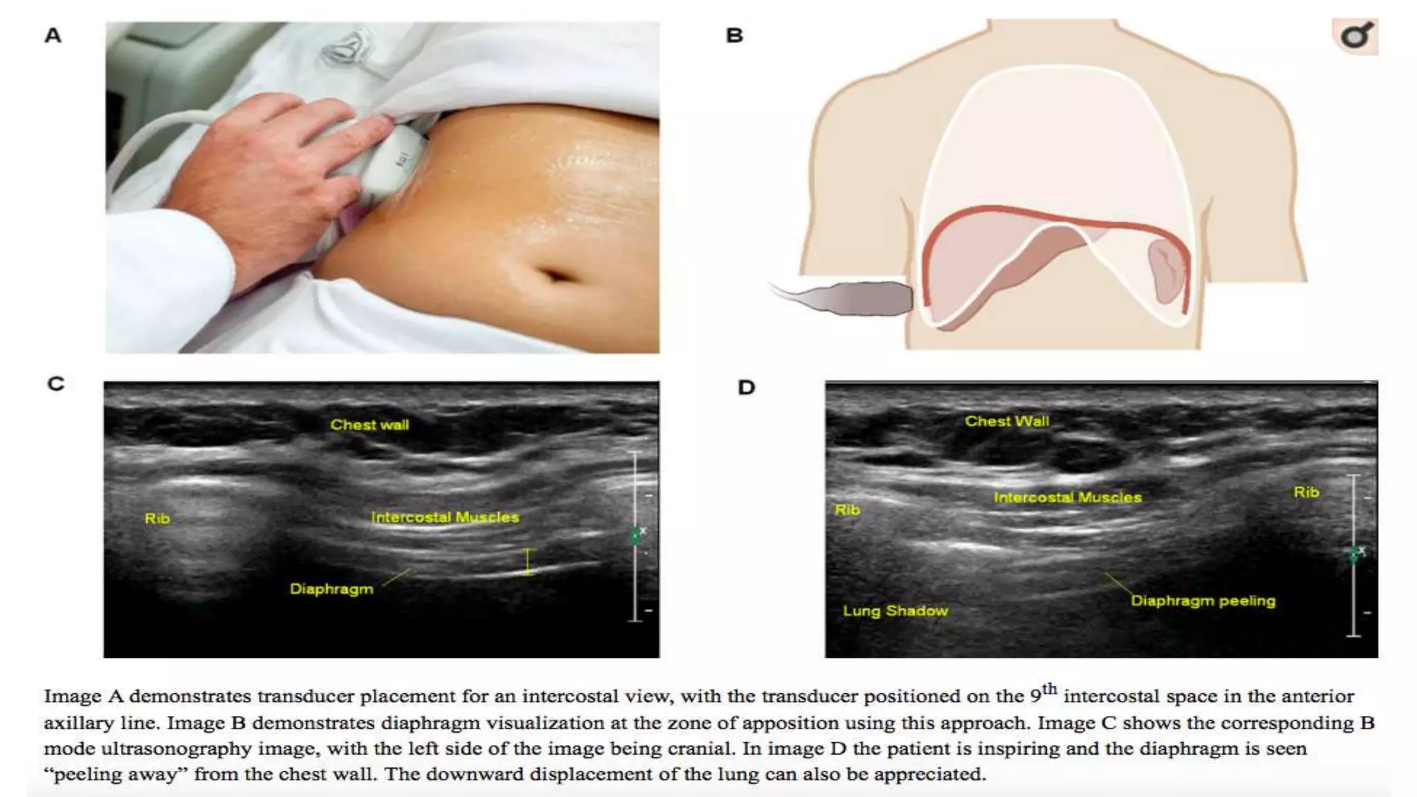 ULTRASONOGRAPHY OF DIAPHRAGM AND ITS CLINICAL IMPLICATION | PPTX