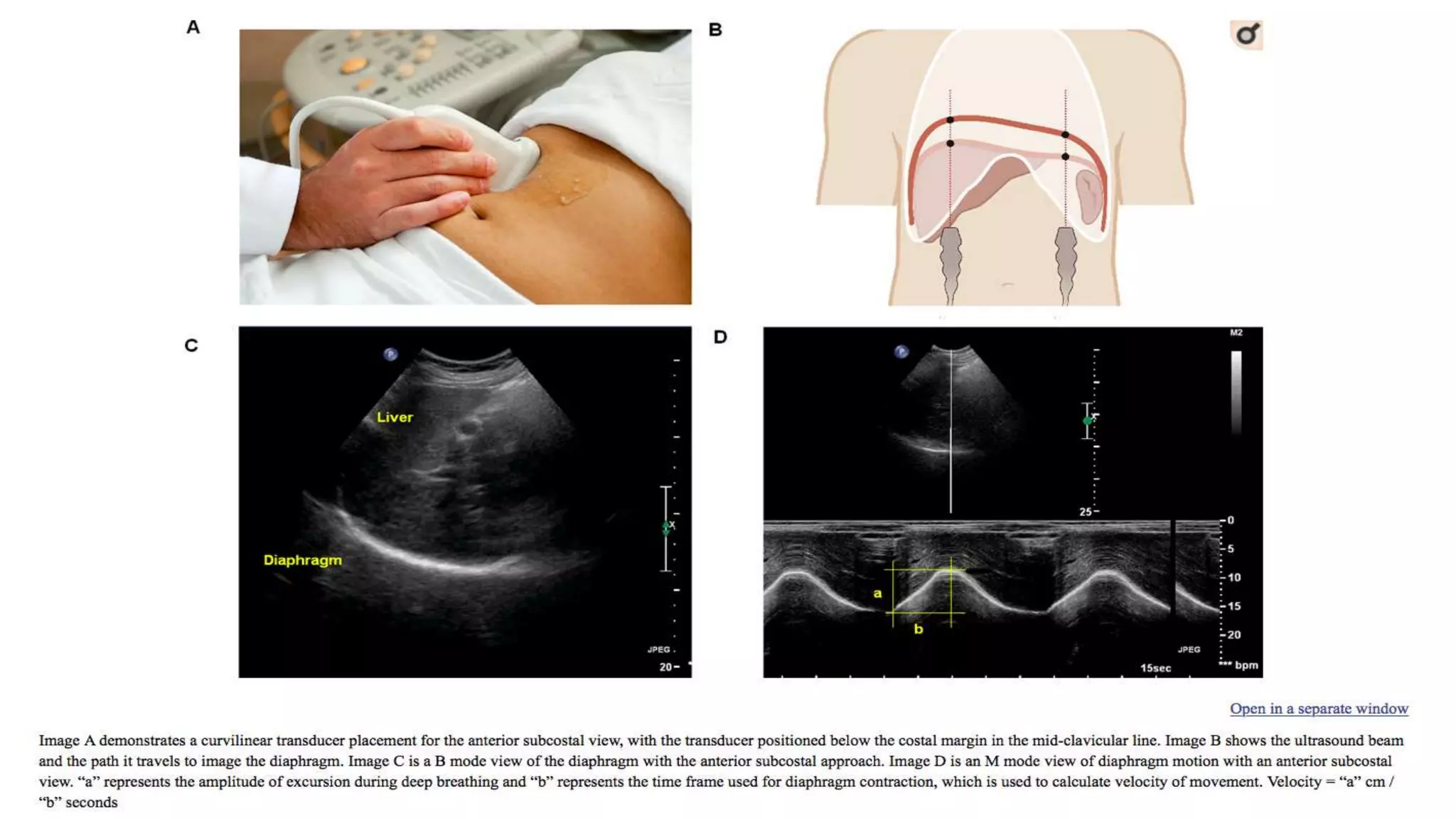 ULTRASONOGRAPHY OF DIAPHRAGM AND ITS CLINICAL IMPLICATION | PPTX