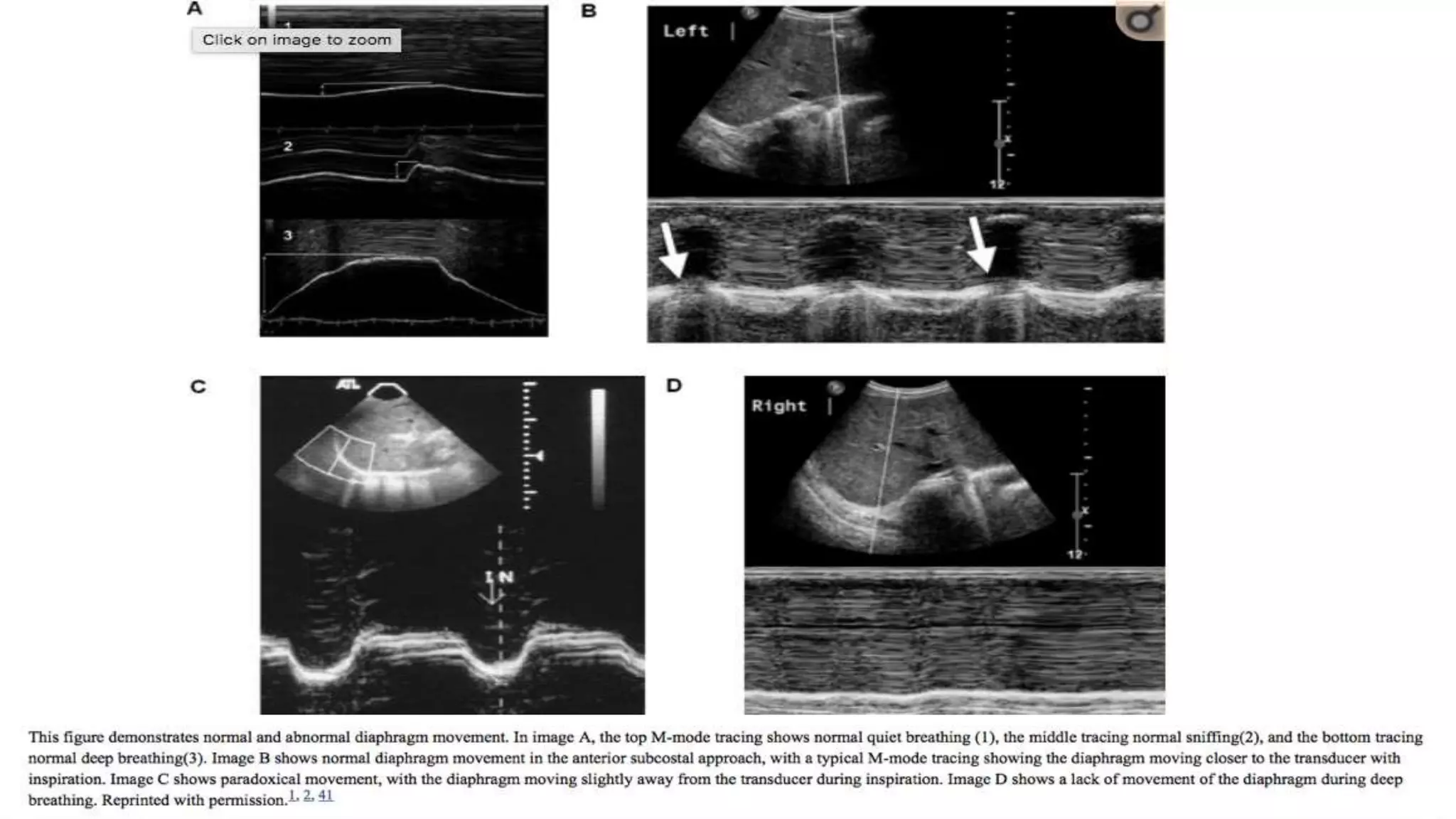 ULTRASONOGRAPHY OF DIAPHRAGM AND ITS CLINICAL IMPLICATION | PPTX