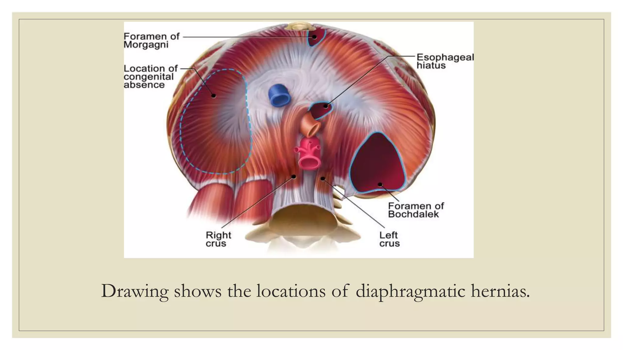 ULTRASONOGRAPHY OF DIAPHRAGM AND ITS CLINICAL IMPLICATION | PPTX