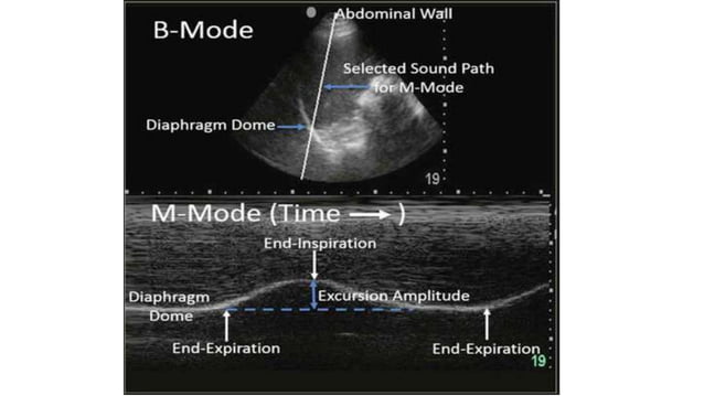 ULTRASONOGRAPHY OF DIAPHRAGM AND ITS CLINICAL IMPLICATION | PPTX ...