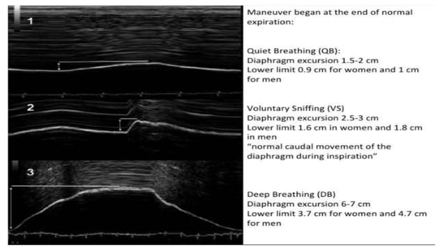 ULTRASONOGRAPHY OF DIAPHRAGM AND ITS CLINICAL IMPLICATION | PPTX ...