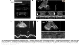ULTRASONOGRAPHY OF DIAPHRAGM AND ITS CLINICAL IMPLICATION | PPTX
