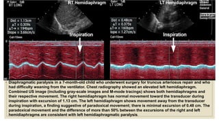 ULTRASONOGRAPHY OF DIAPHRAGM AND ITS CLINICAL IMPLICATION | PPTX