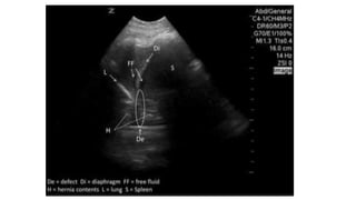 ULTRASONOGRAPHY OF DIAPHRAGM AND ITS CLINICAL IMPLICATION | PPTX