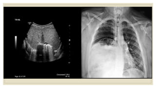ULTRASONOGRAPHY OF DIAPHRAGM AND ITS CLINICAL IMPLICATION | PPTX
