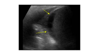 ULTRASONOGRAPHY OF DIAPHRAGM AND ITS CLINICAL IMPLICATION | PPTX
