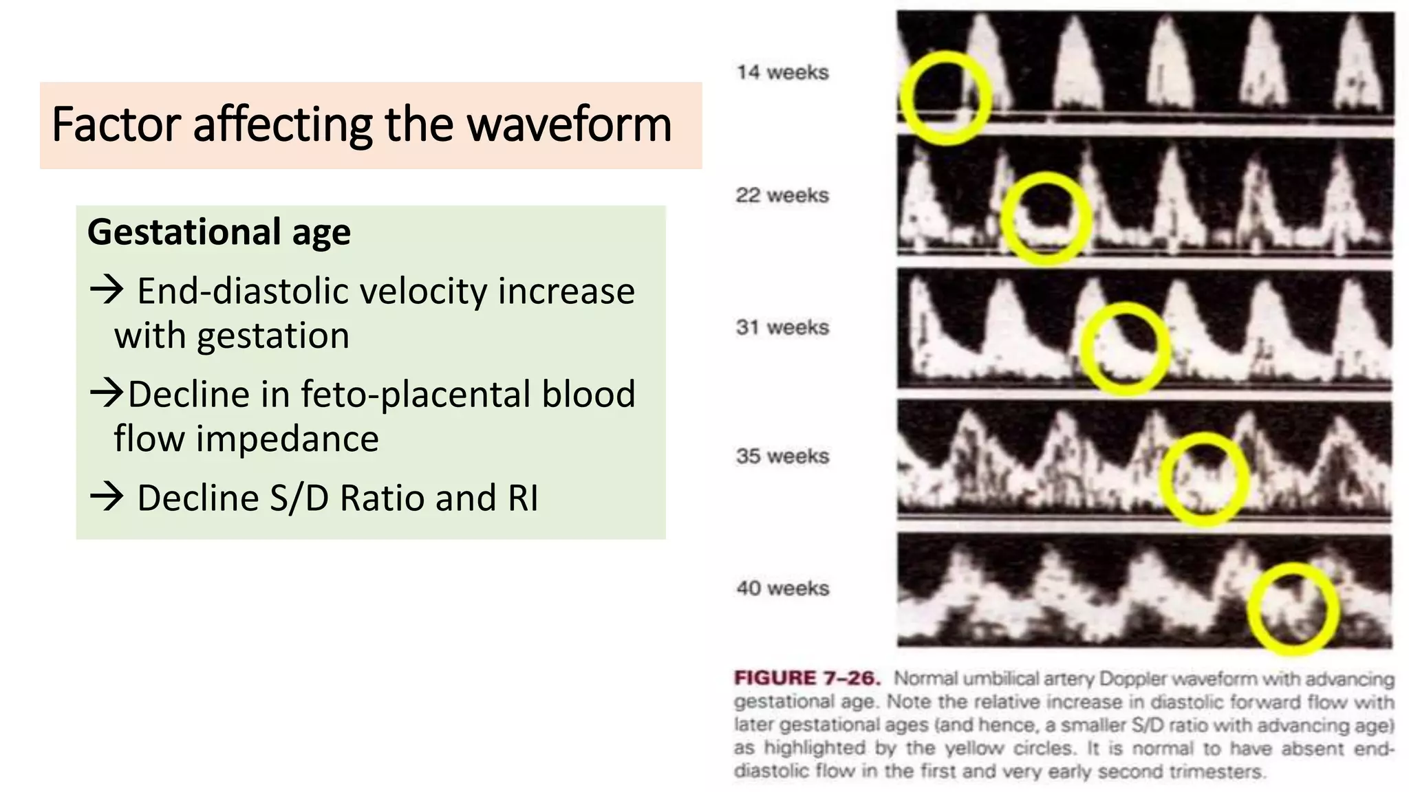 Doppler Ultrasound of Umbilical Artery | PPTX