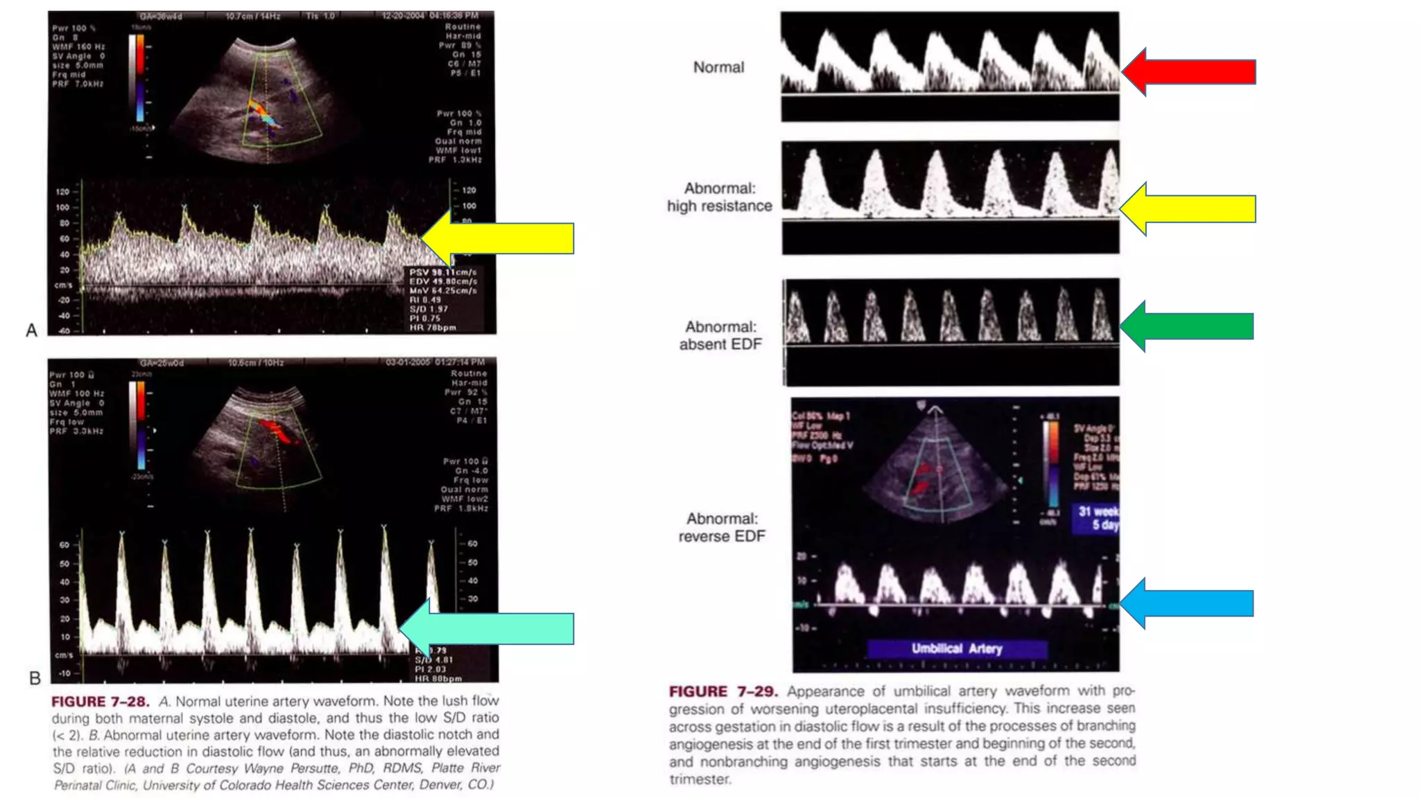 Doppler Ultrasound of Umbilical Artery | PPTX