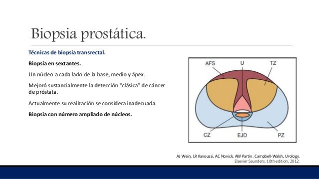 BIOPSIA DE PROSTATA POR USG