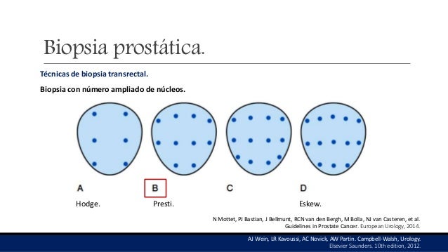 BIOPSIA DE PROSTATA POR USG