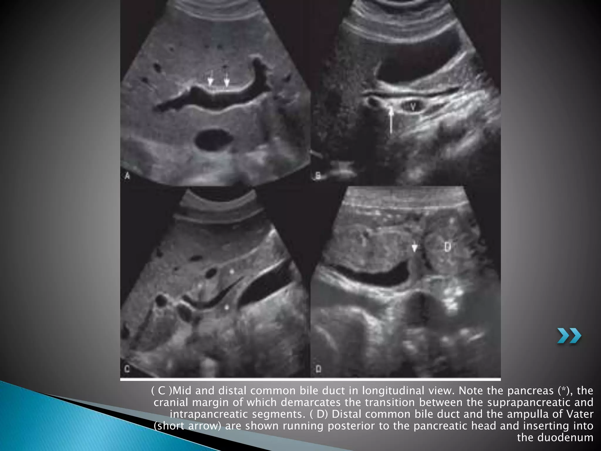 Usg evolution of biliary tree and gallbladder.pptx