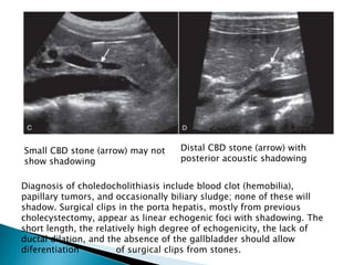 Usg evolution of biliary tree and gallbladder.pptx