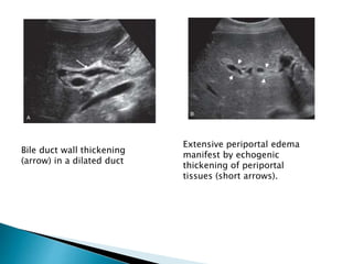 Usg evolution of biliary tree and gallbladder.pptx