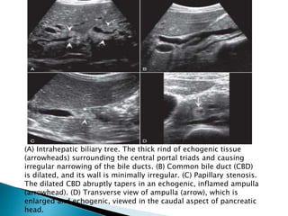 Usg evolution of biliary tree and gallbladder.pptx